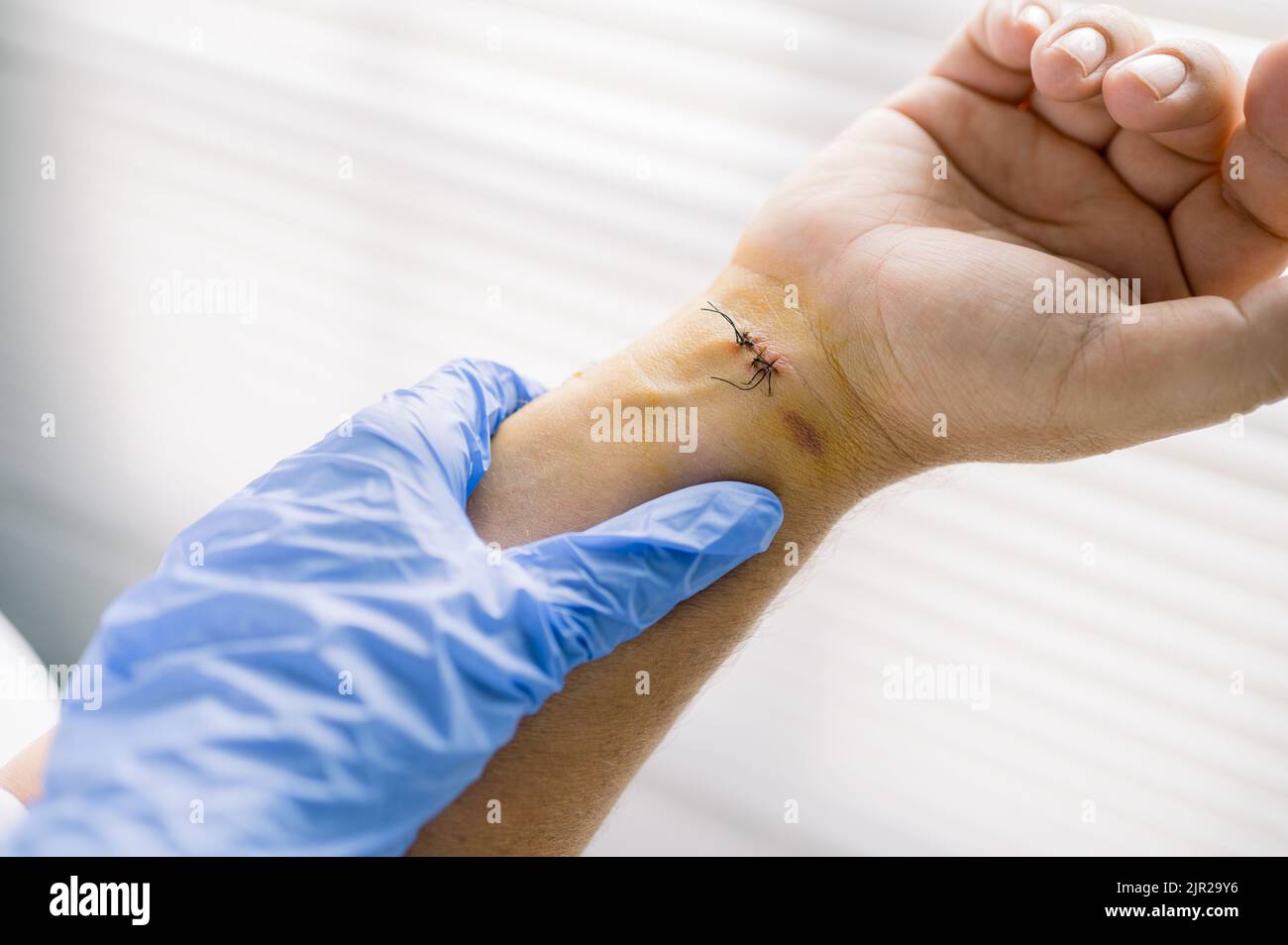 Crop doctor examining stitches on wound Stock Photo - Alamy