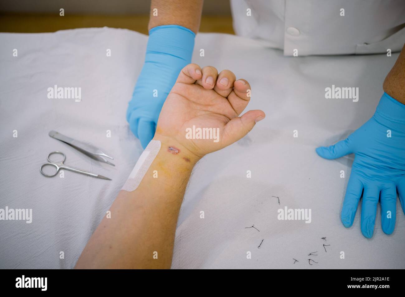 Stitch removal hi-res stock photography and images - Alamy