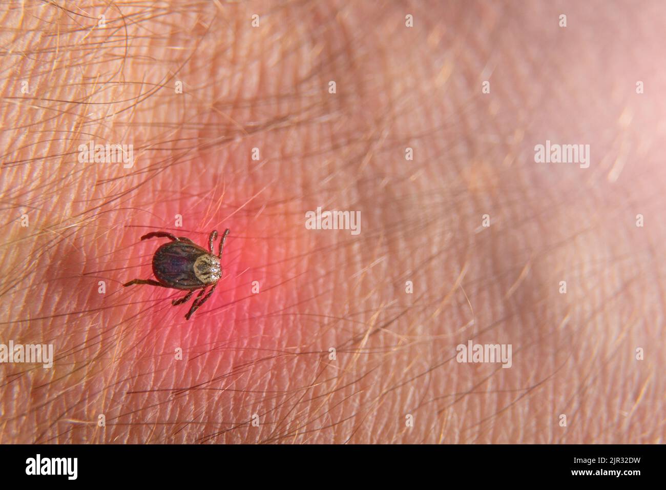 Deer tick on skin hi-res stock photography and images - Alamy