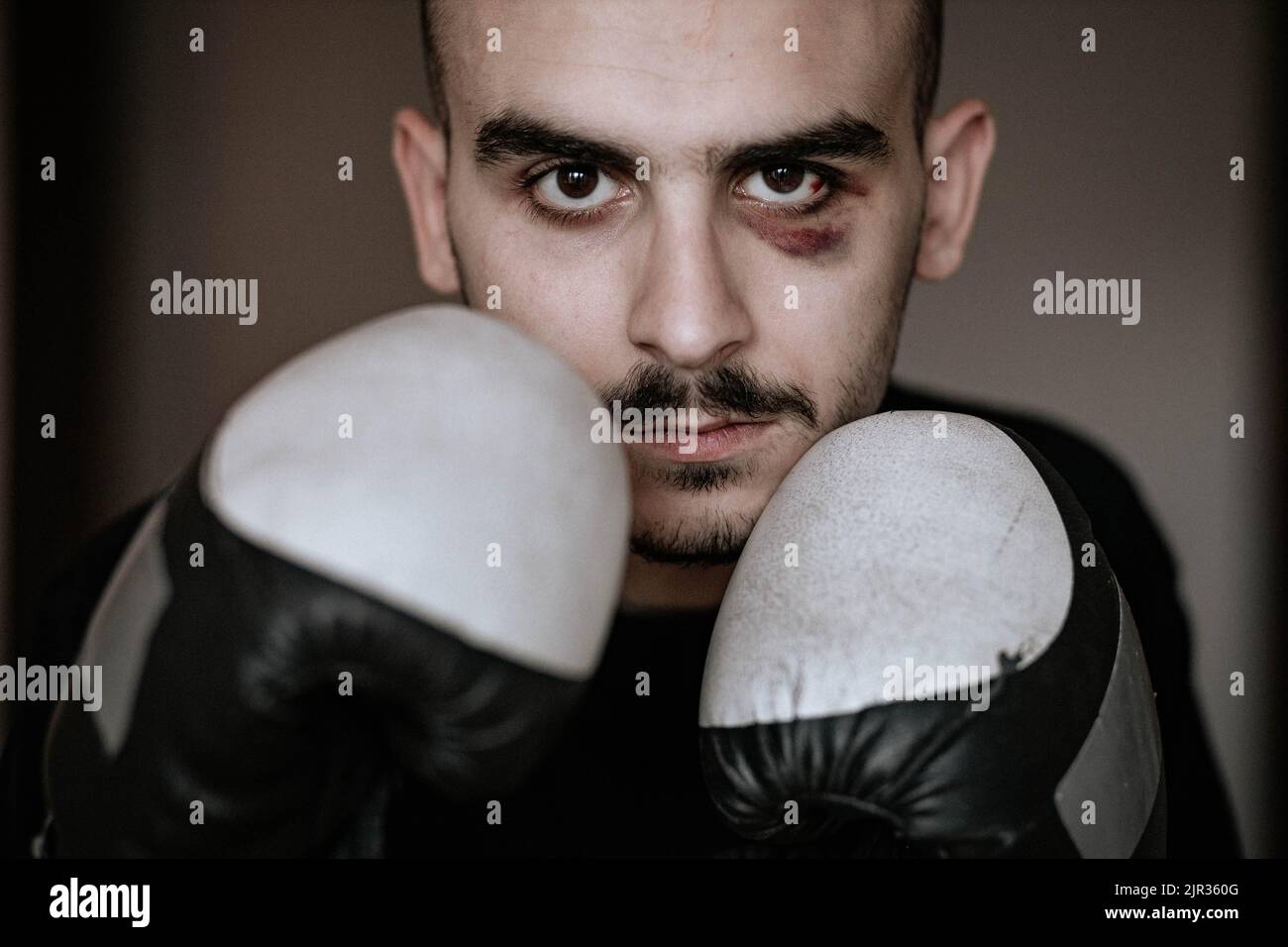 Young male with bruise under his eye with boxing gloves Stock Photo - Alamy