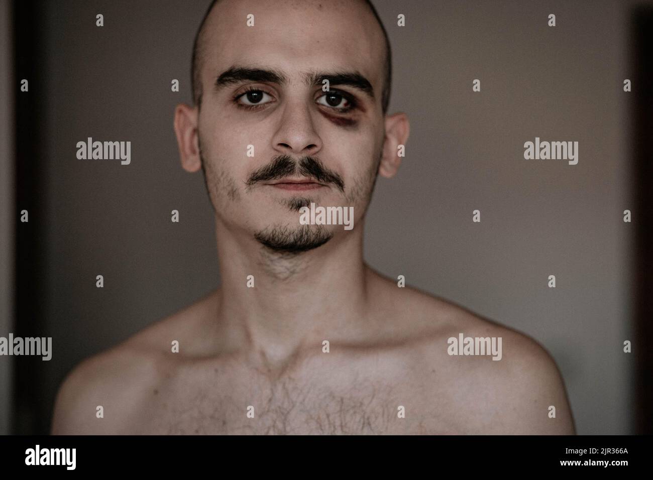 Injured young man with bruises on his face Stock Photo - Alamy