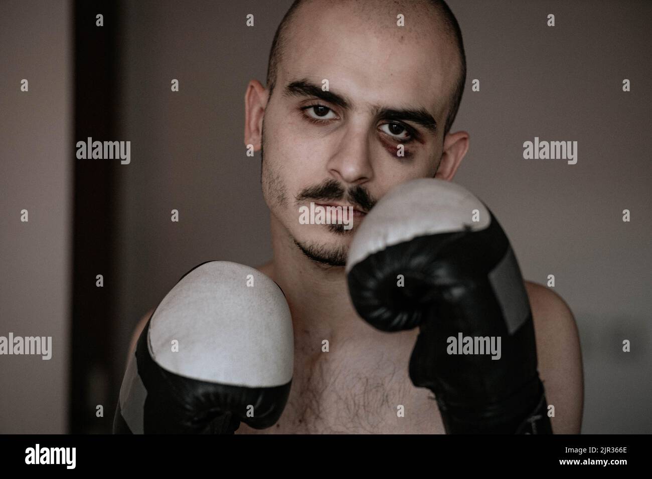 Young male with bruise under his eye with boxing gloves Stock Photo - Alamy