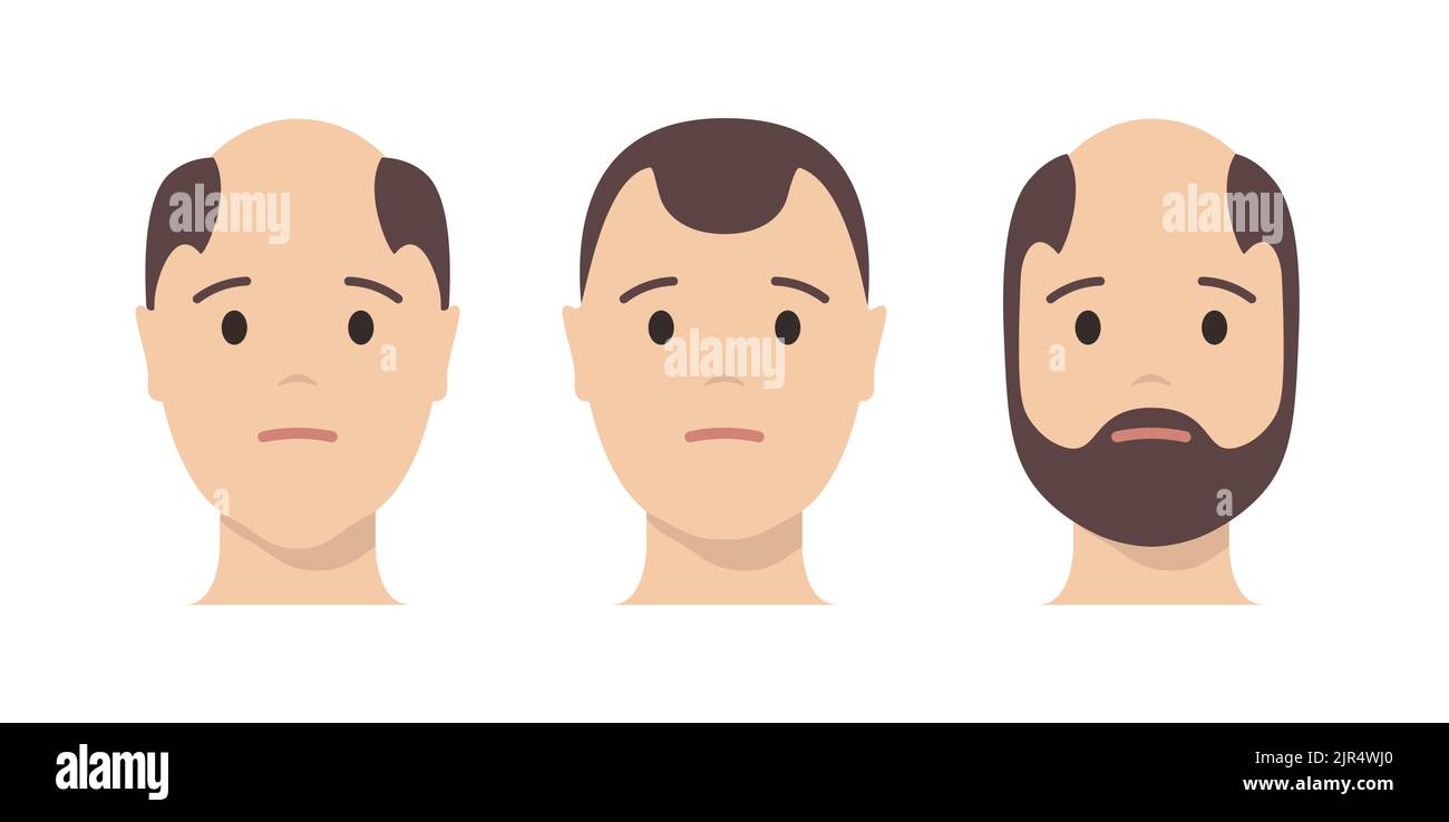 Hair loss man icon cartoon vector logo. Hair loss male scalp bald ...