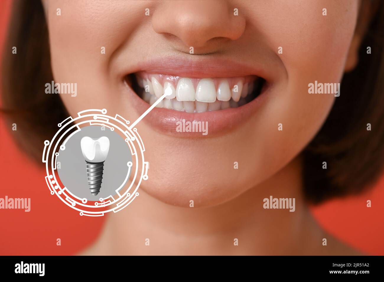 Woman implantation hi-res stock photography and images - Alamy