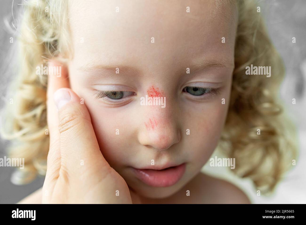 Close-up of the face of a sad child with a scratch on his nose Stock ...