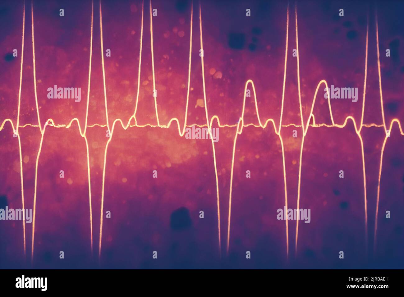 Electrocardiogram, EKG, heart rate monitor showing a specific illness ...