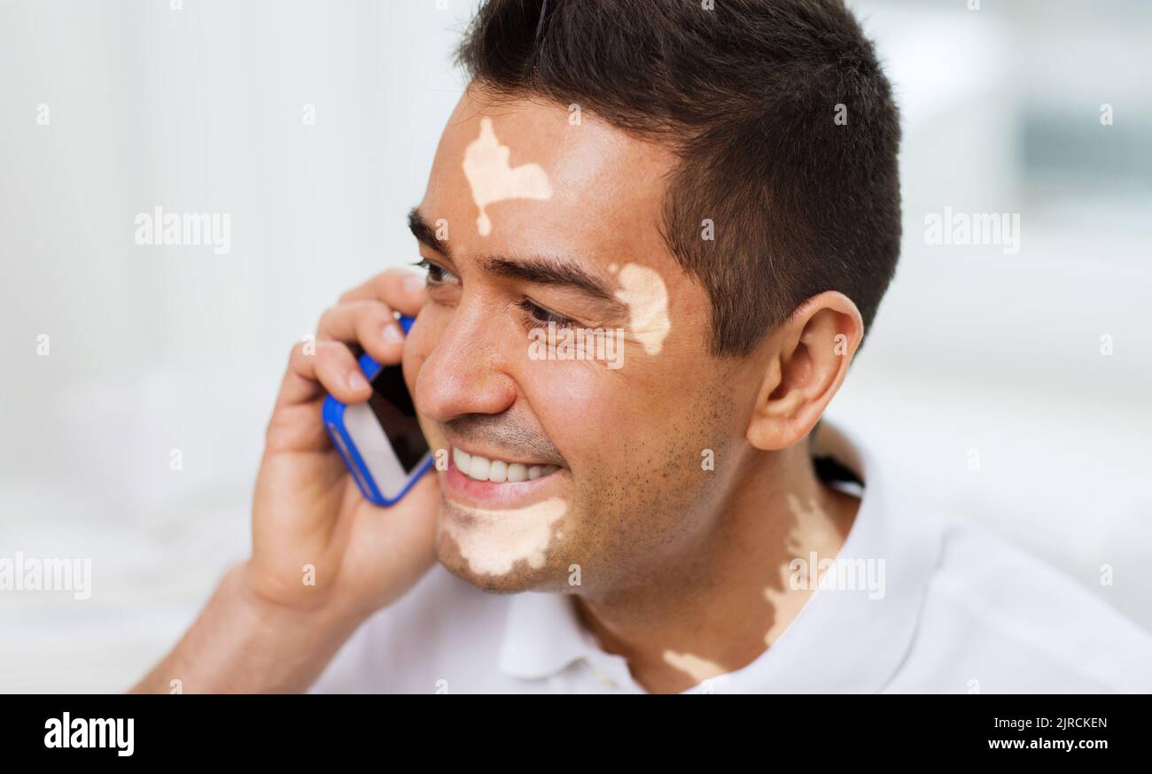 Vitiligo face hi-res stock photography and images - Alamy