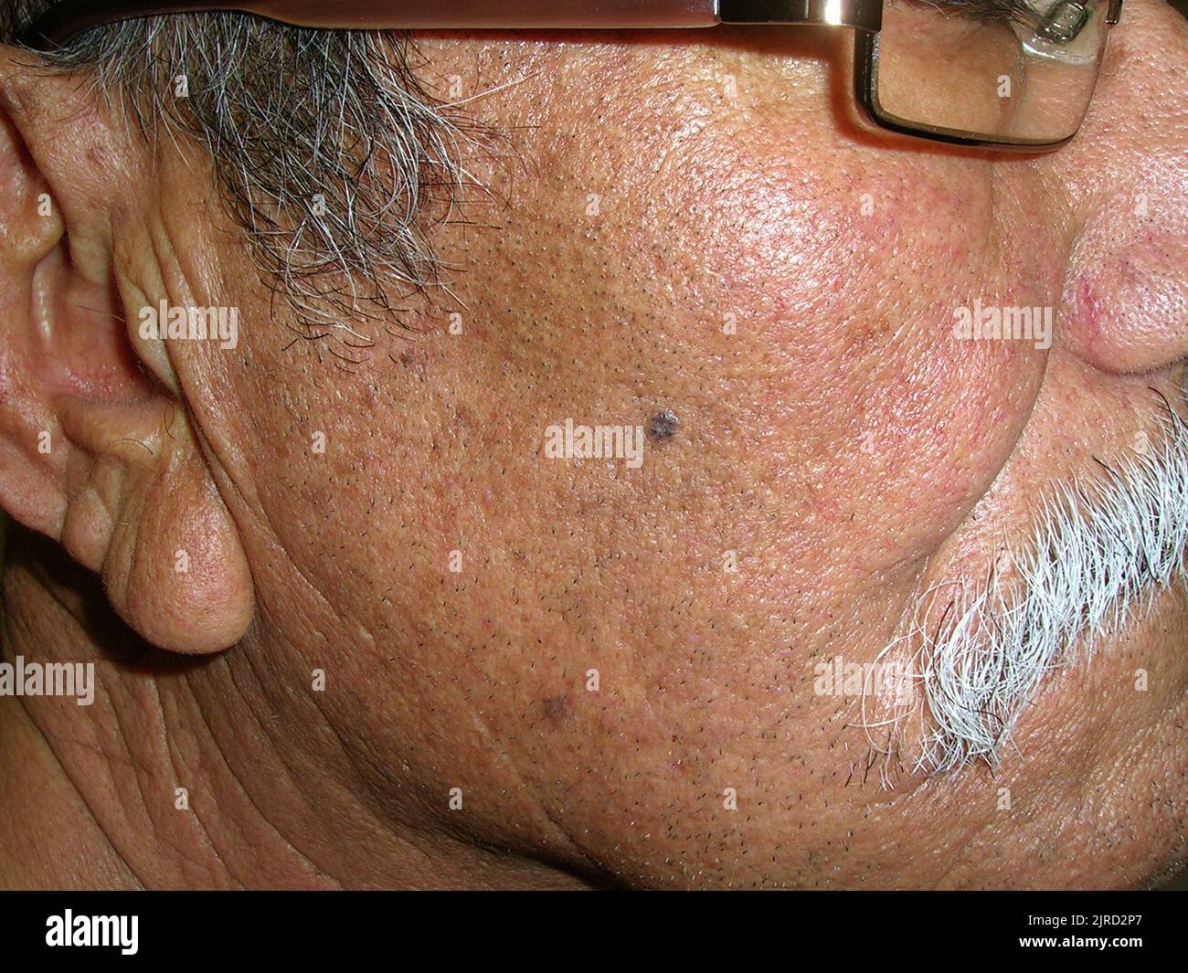 Basal cell carcinoma Stock Photo - Alamy