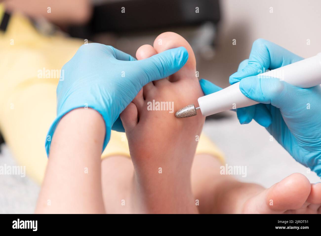 Chiropodist in blue medical goves does hardware peeling of the skin of ...