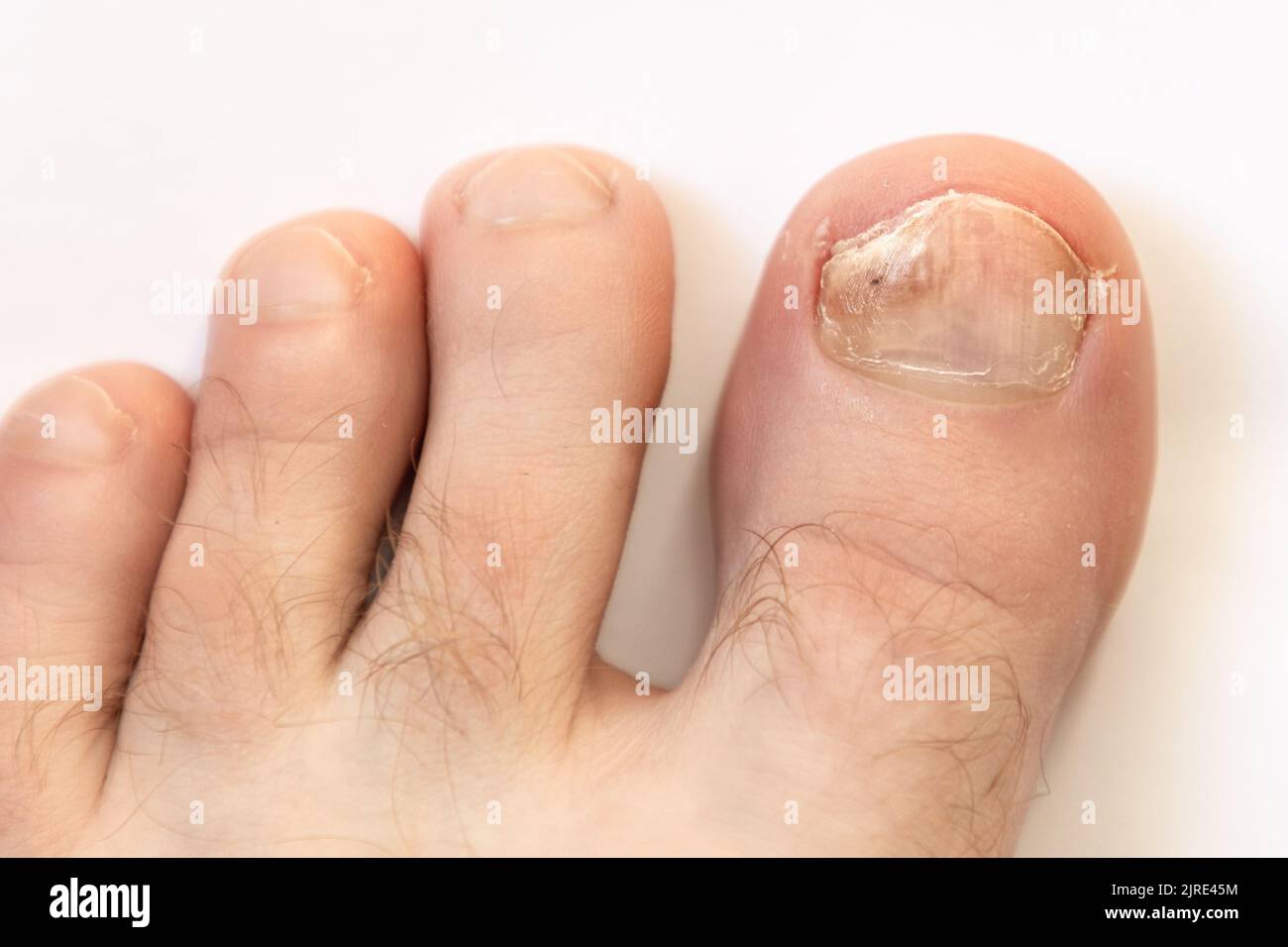 A man's foot with a damaged nail damaged by fungus. Top view. White ...