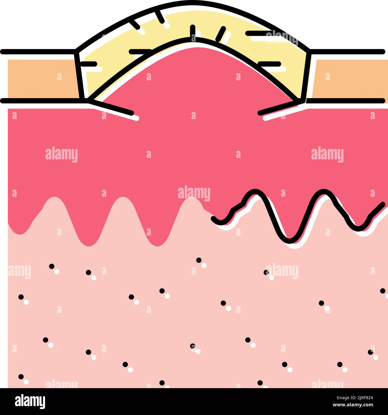 boxcar acne scar color icon vector illustration Stock Vector Image ...