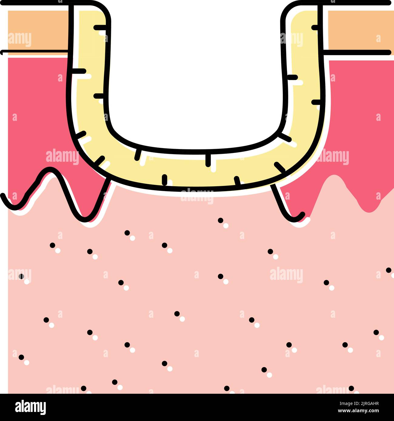 hypertrophic acne scar color icon vector illustration Stock Vector ...