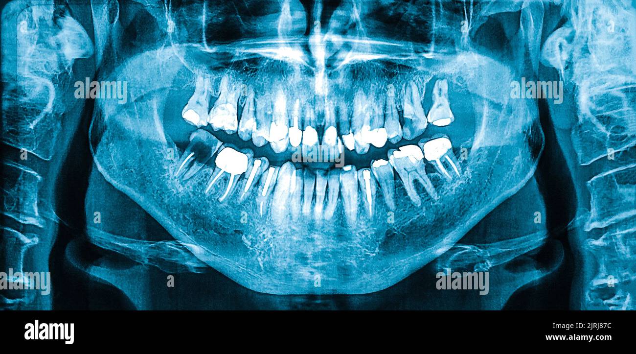 Orthopantomogram radiograph hi-res stock photography and images - Alamy
