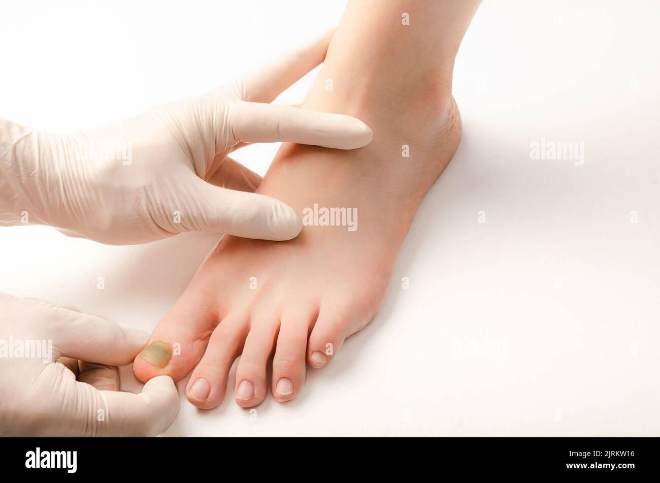 Doctor with white gloves, takes in his hands subungual hematoma in the ...