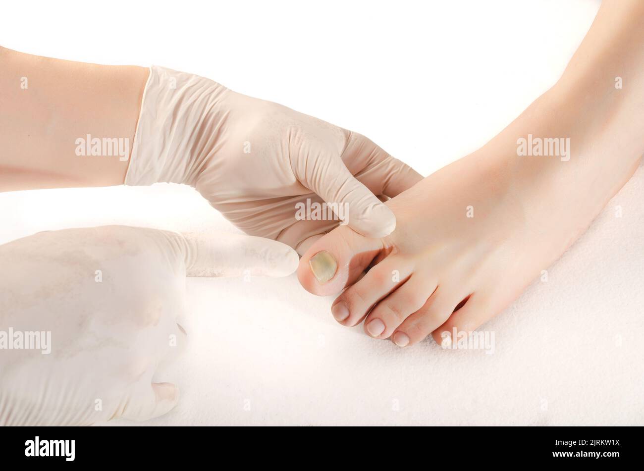 Doctor with white gloves, takes in his hands subungual hematoma in the ...