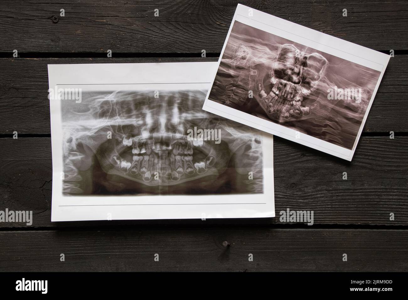 A panoramic X-ray shows several embedded and impacted teeth on both the ...