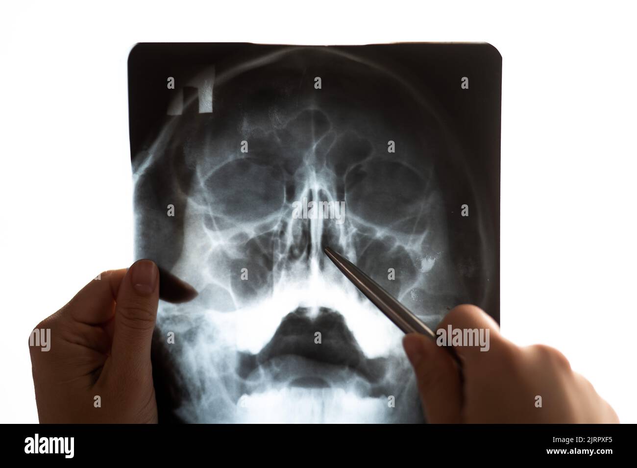 Sinuses x ray hi-res stock photography and images - Alamy