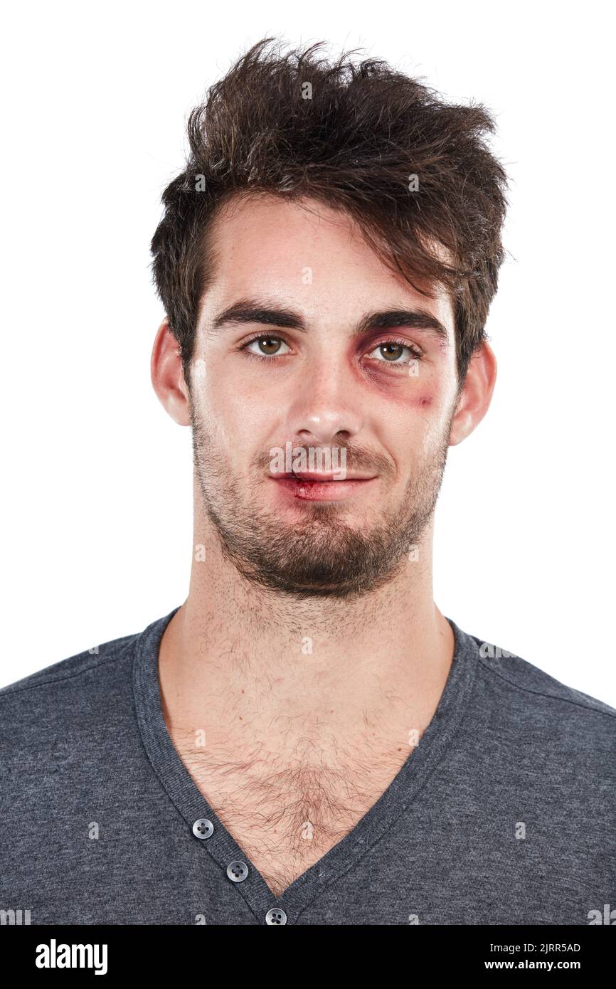 These bruises will heal. Studio portrait of a young man with scratches ...