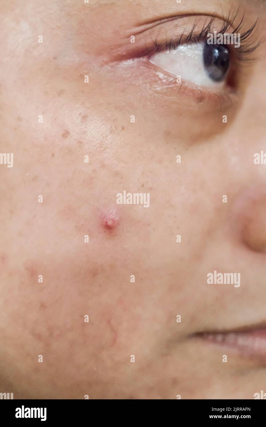 Side profile of the face of an Asian woman with pimple and freckles and ...