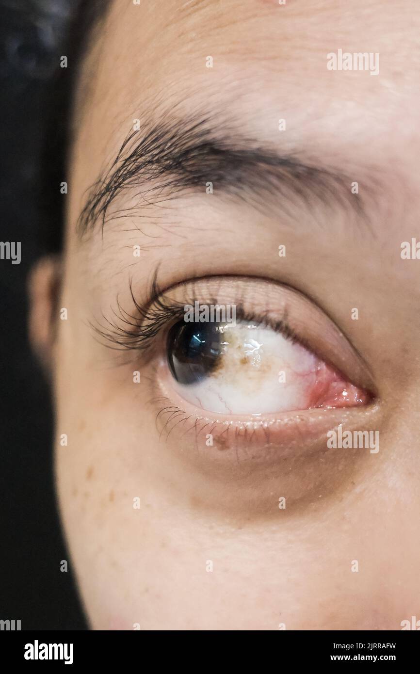 Closeup woman with Brown Spot on her Sclera Diagnosed as Hemorrhagic ...