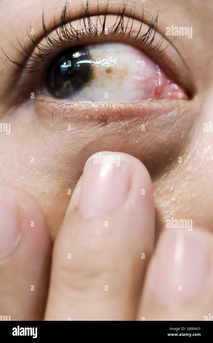 A Woman with Brown Spot on her Sclera Diagnosed as Hemorrhagic ...