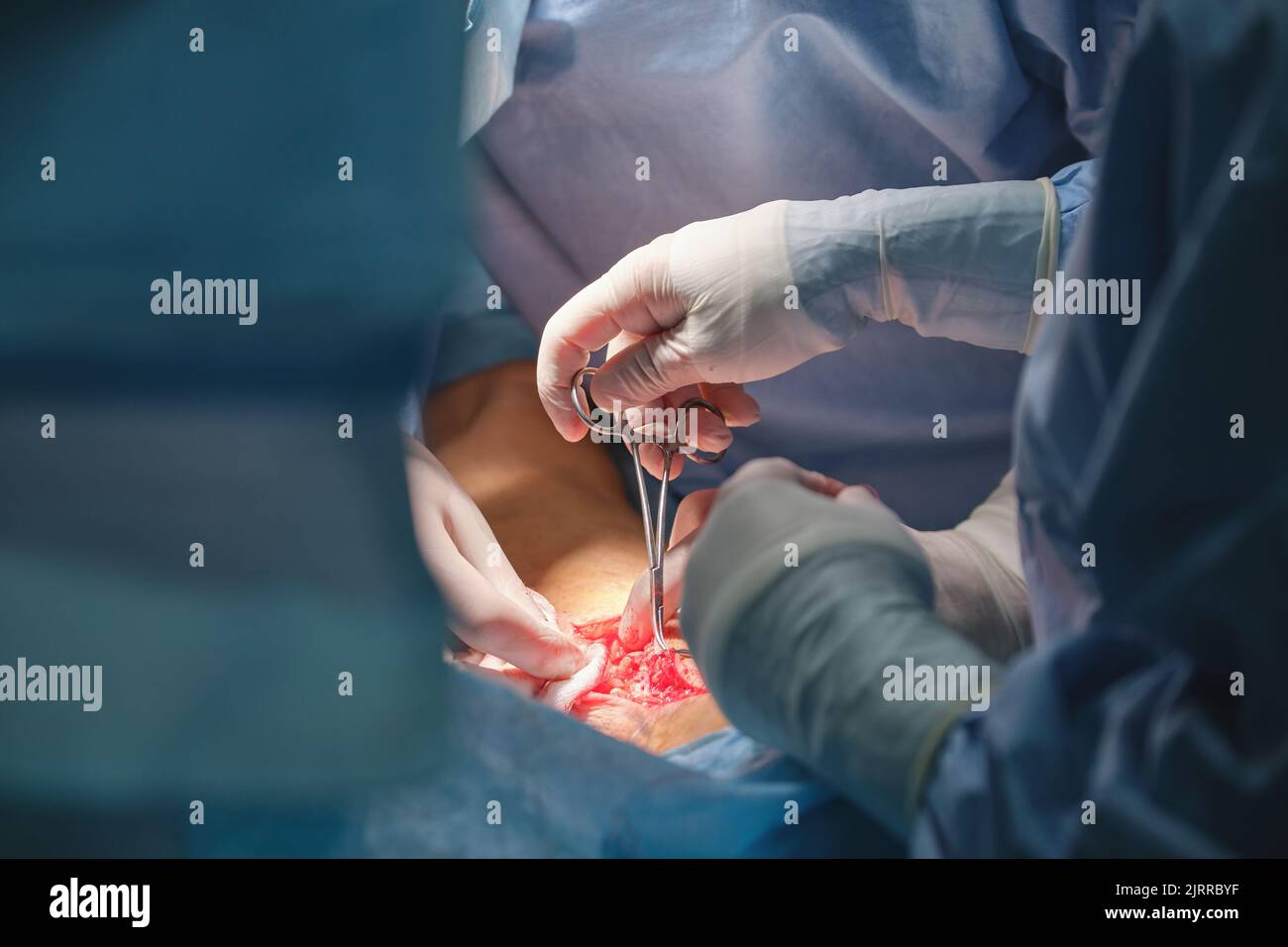 Closeup of doctors hands operating a patient conducting open cut ...