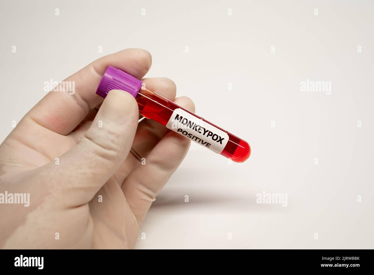 Close-up of Blood sample tube positive with Monkeypox virus, new ...