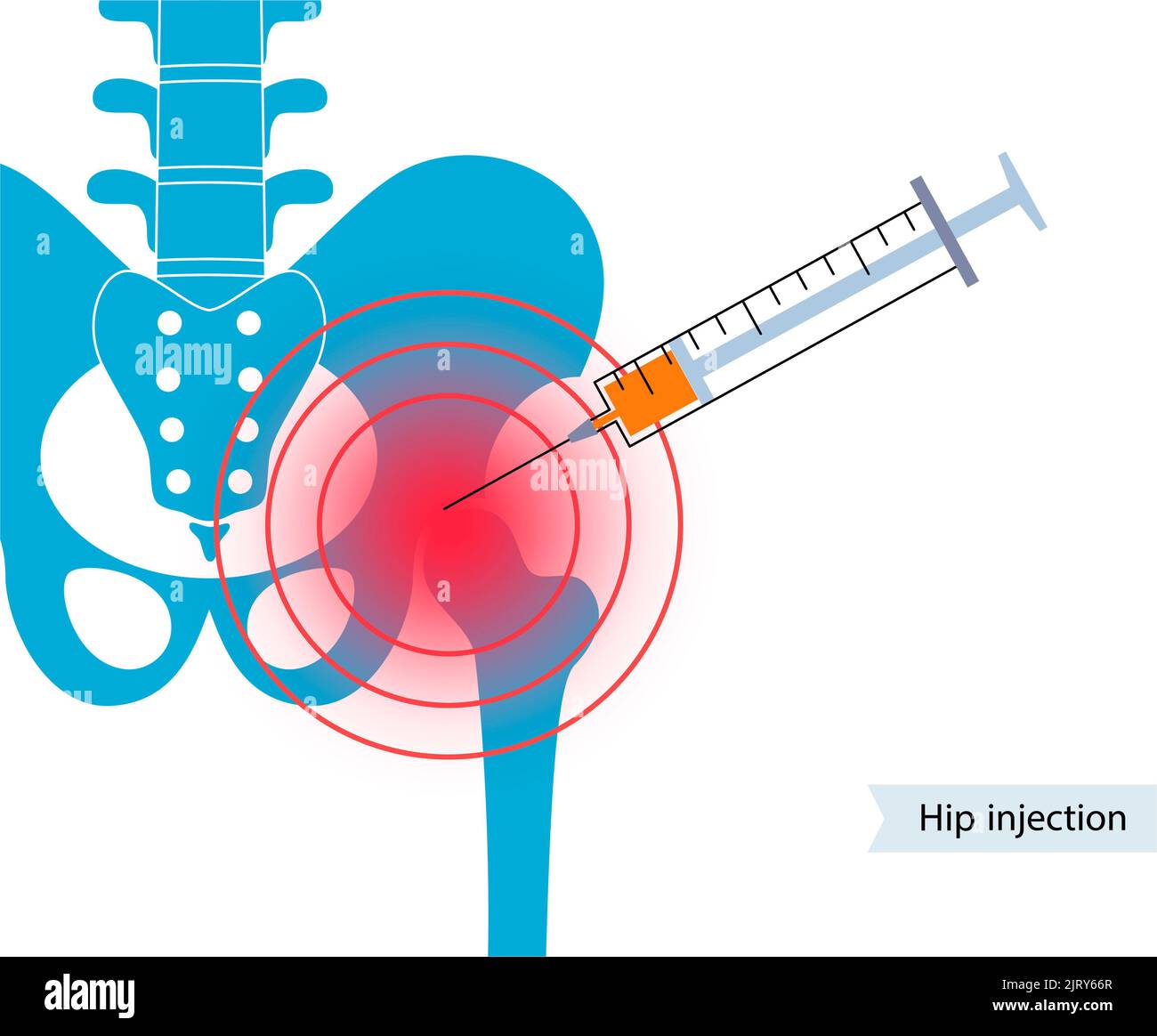Sacroiliac joint injection hi-res stock photography and images - Alamy