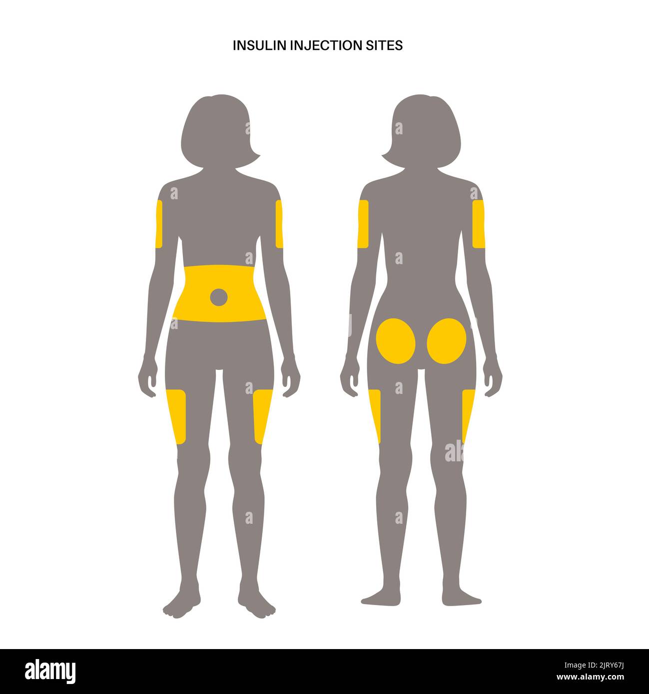 Insulin injection sites, illustration Stock Photo - Alamy Insulin injection sites, illustration Stock Photo - Alamy