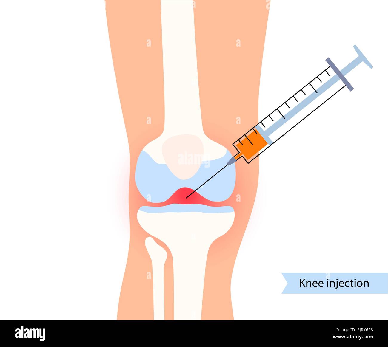 Knee injection, illustration Stock Photo - Alamy