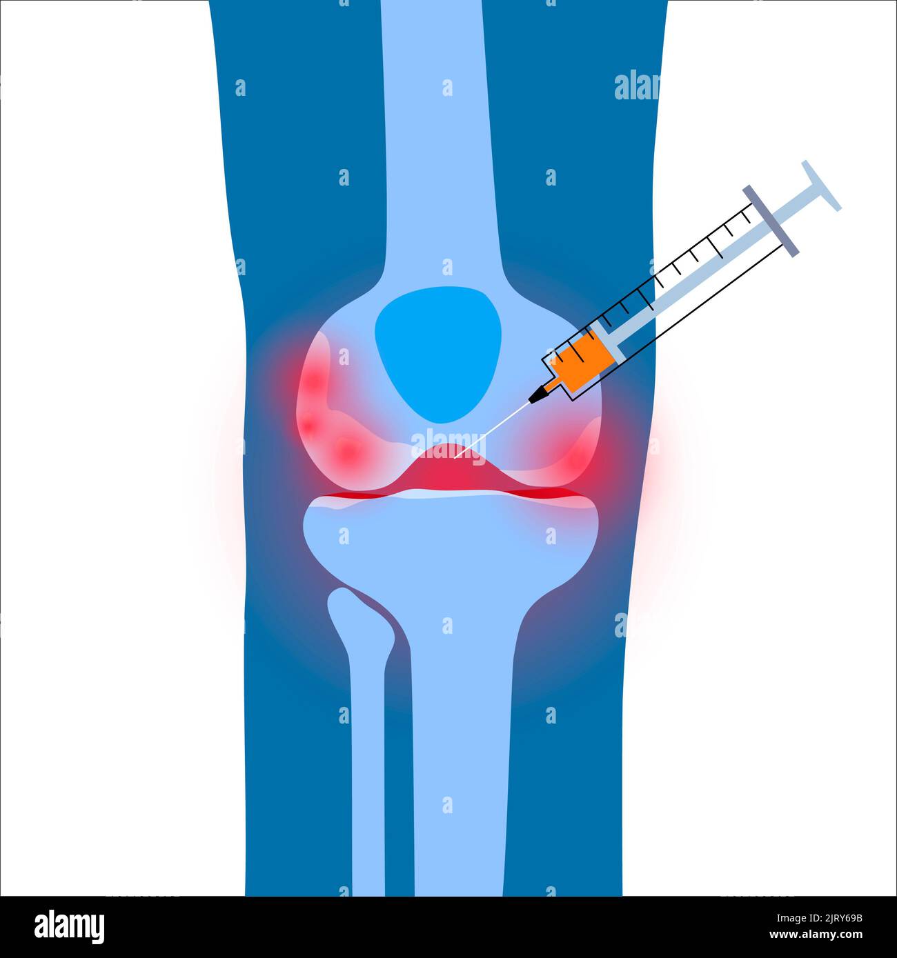 Knee injection, illustration Stock Photo - Alamy