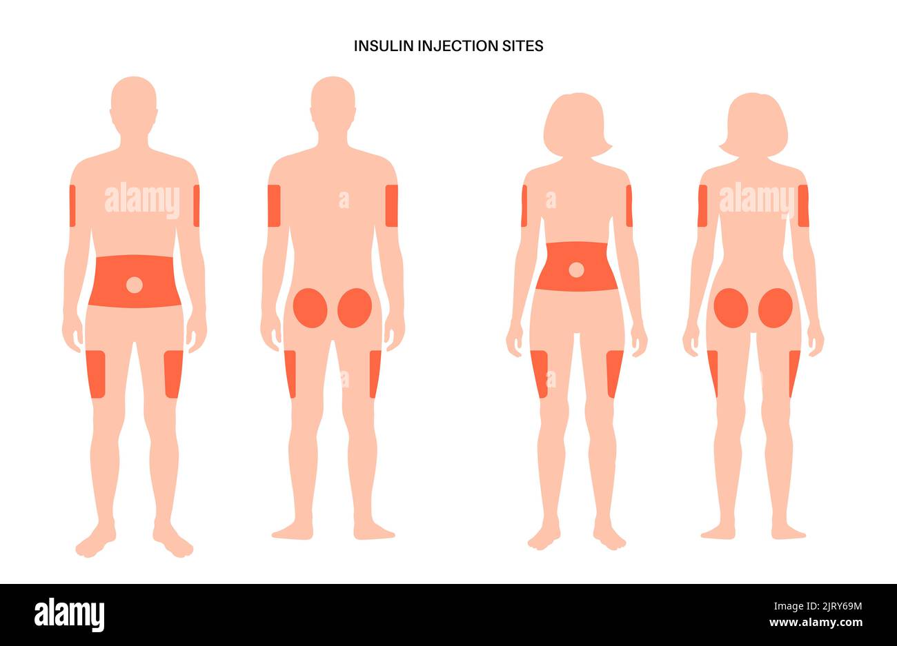 Insulin injection sites, illustration Stock Photo - Alamy Insulin injection sites, illustration Stock Photo - Alamy