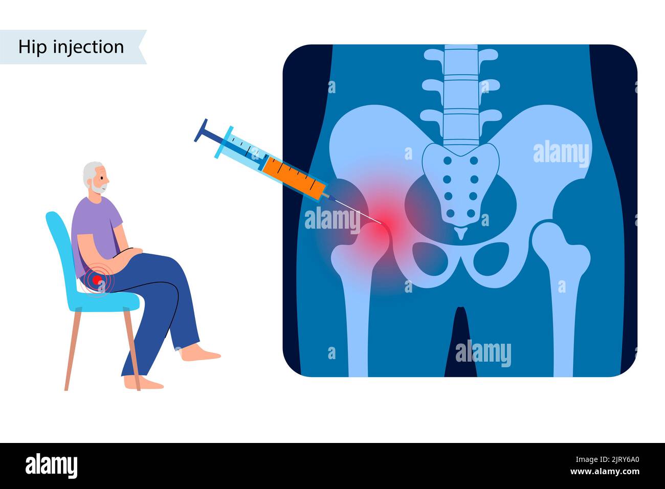 Hip joint injection, illustration Stock Photo - Alamy