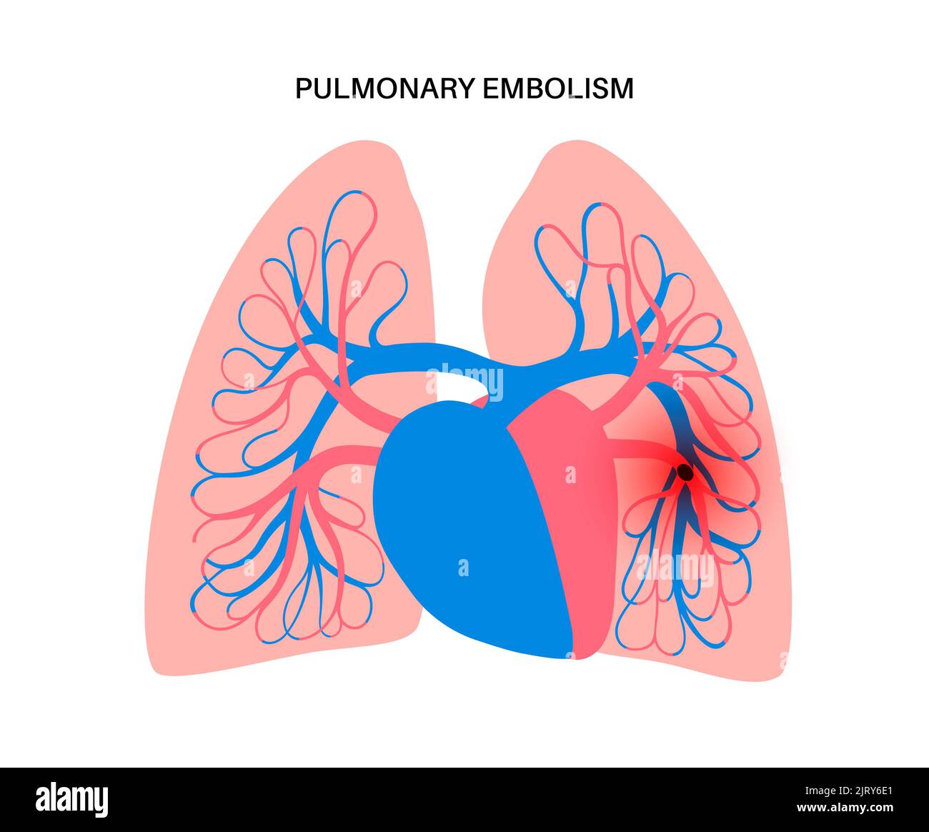 Pulmonary embolism, illustration Stock Photo - Alamy