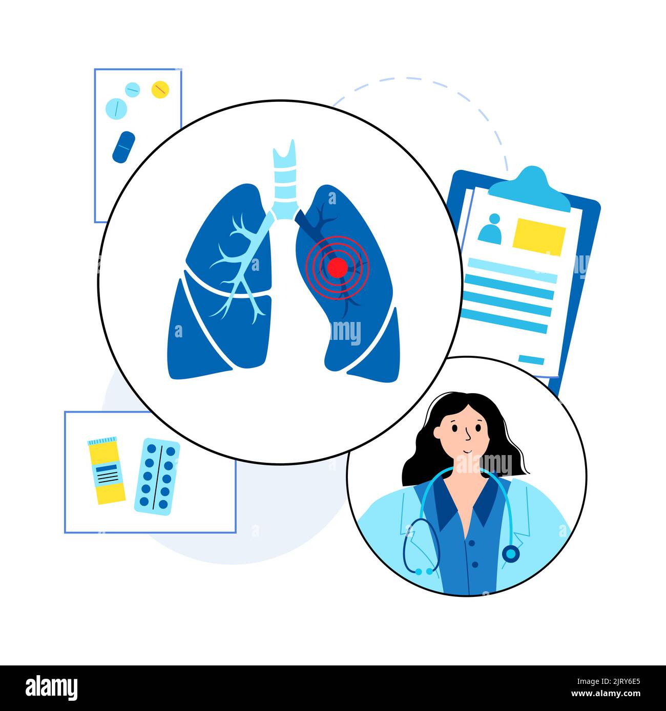 Pulmonary embolism treatment, illustration Stock Photo - Alamy