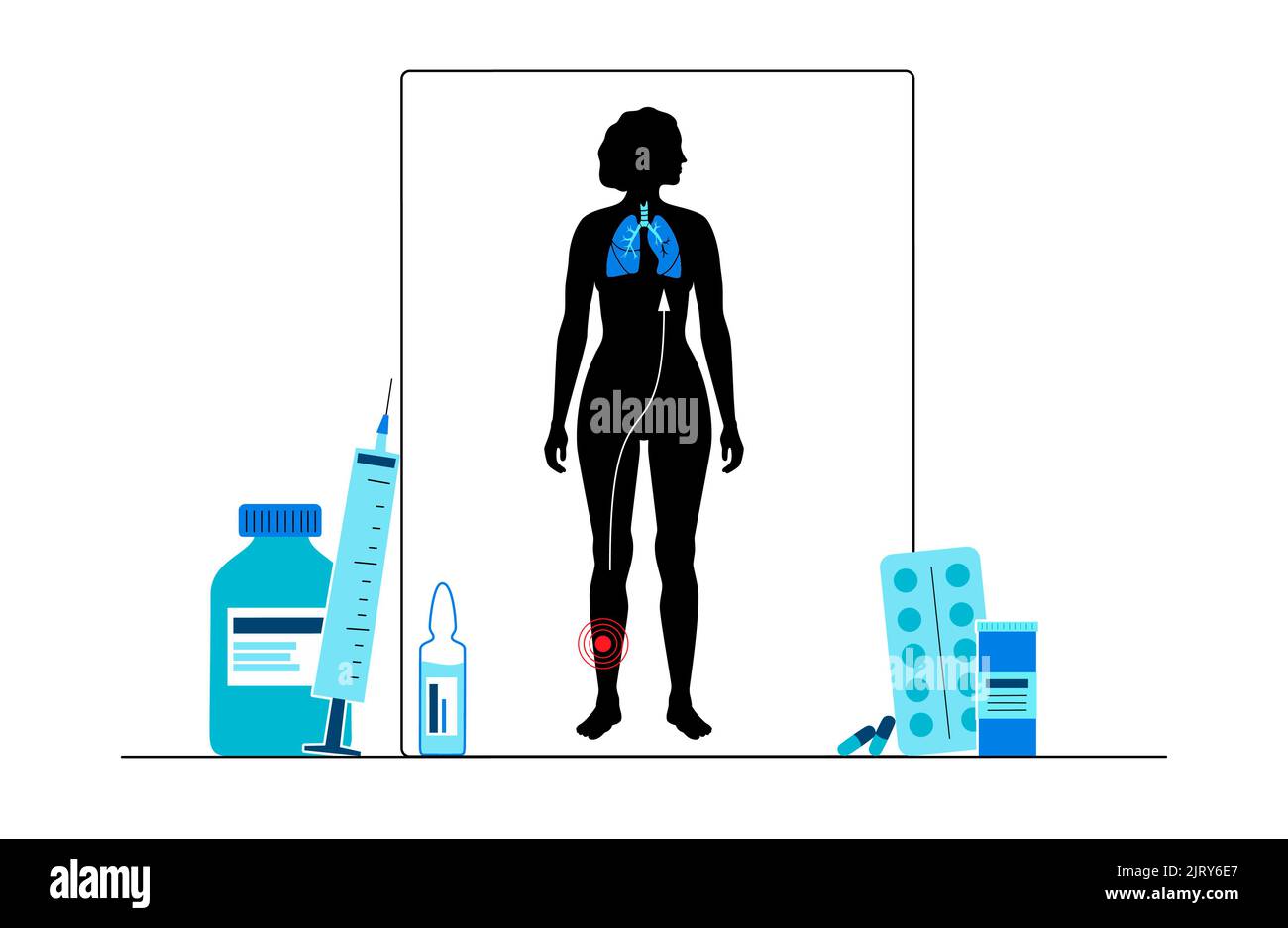 Pulmonary embolism treatment, illustration Stock Photo - Alamy