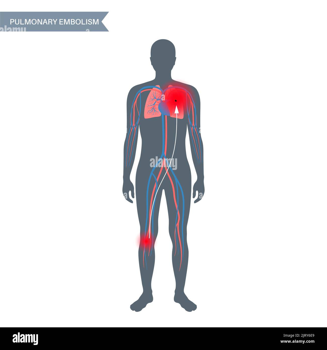 Thrombus lung hi-res stock photography and images - Alamy