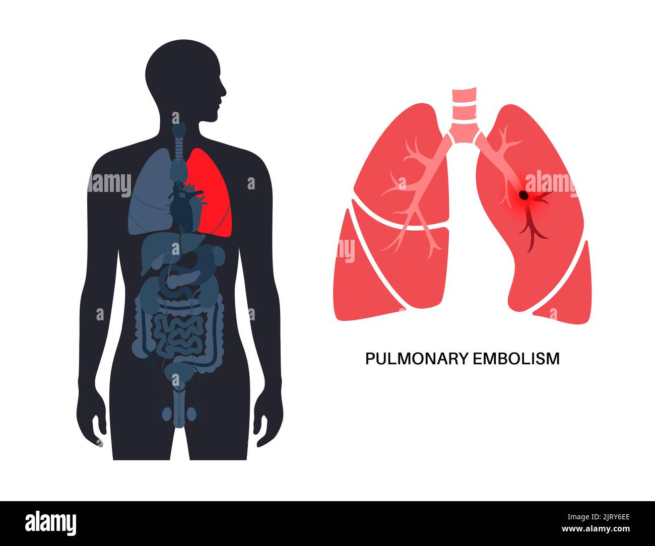 Pulmonary embolism, illustration Stock Photo - Alamy