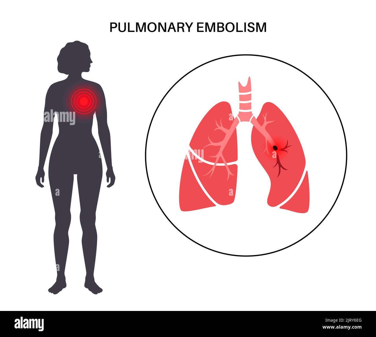Pulmonary embolism, illustration Stock Photo - Alamy