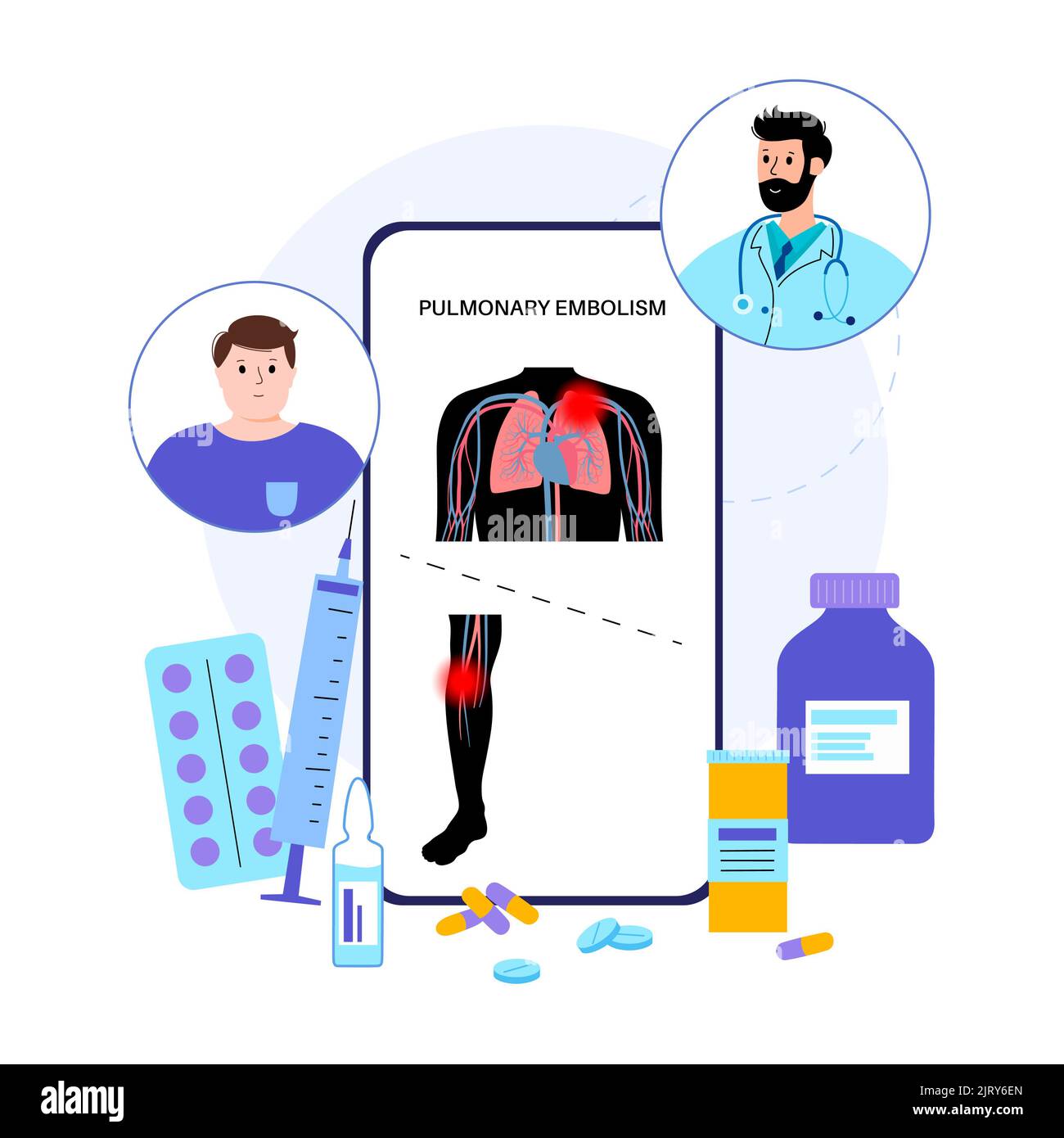 Pulmonary embolism treatment, illustration Stock Photo - Alamy