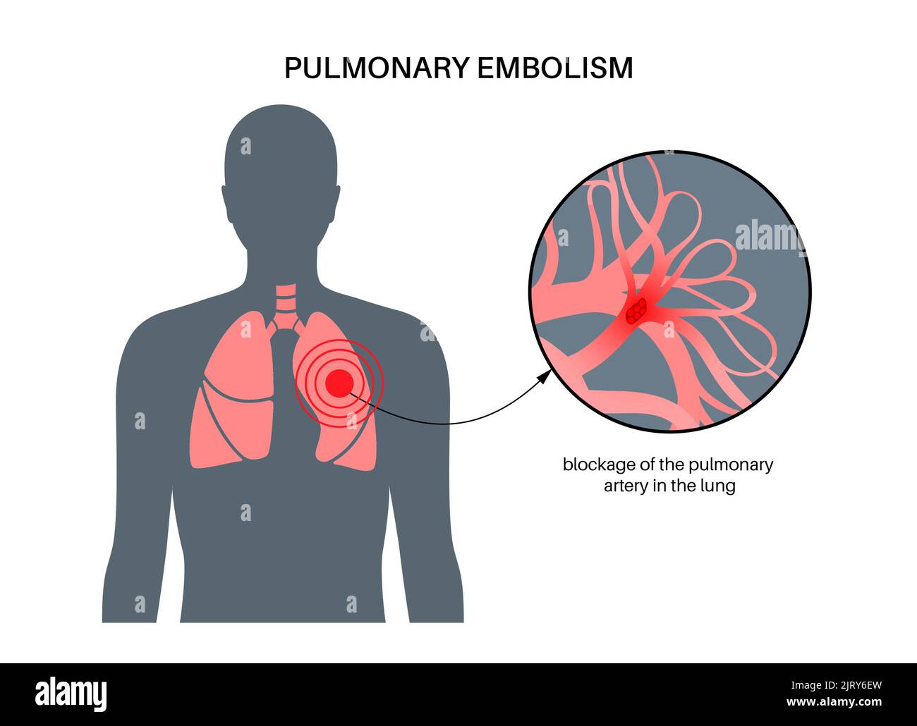 Pulmonary embolism, illustration Stock Photo - Alamy