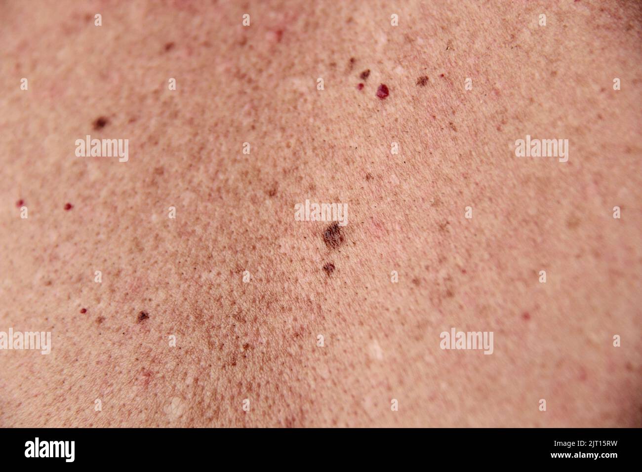 Skin Macro Close-up with Capillaries and Sun Spots, Moles. Red and ...