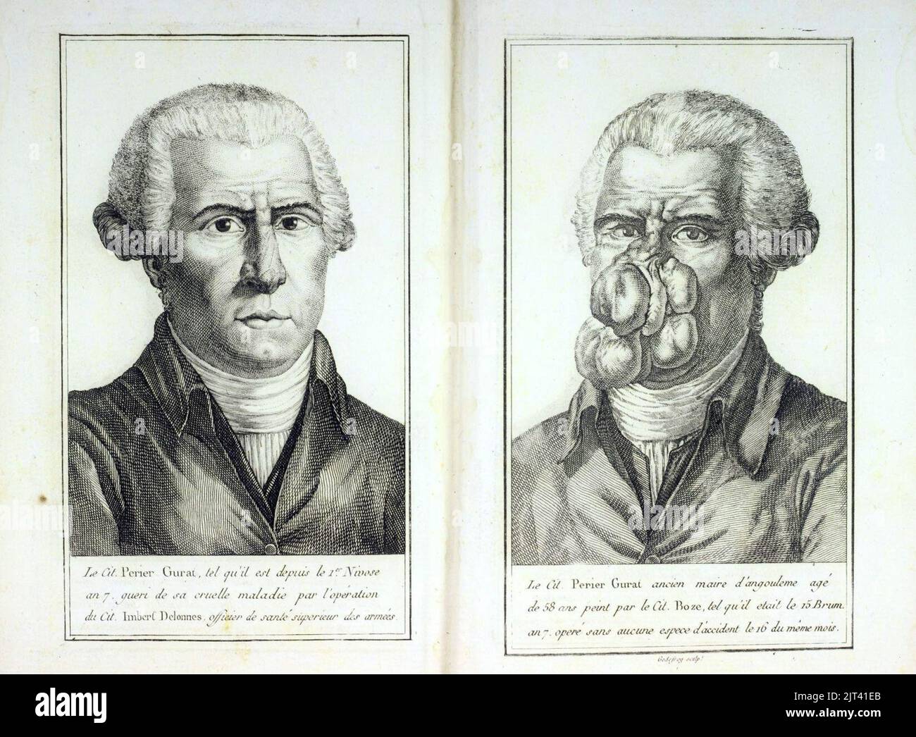 Tumeur du nez opérée par Ange-Bernard d'Imbert de Lonnes Stock Photo ...