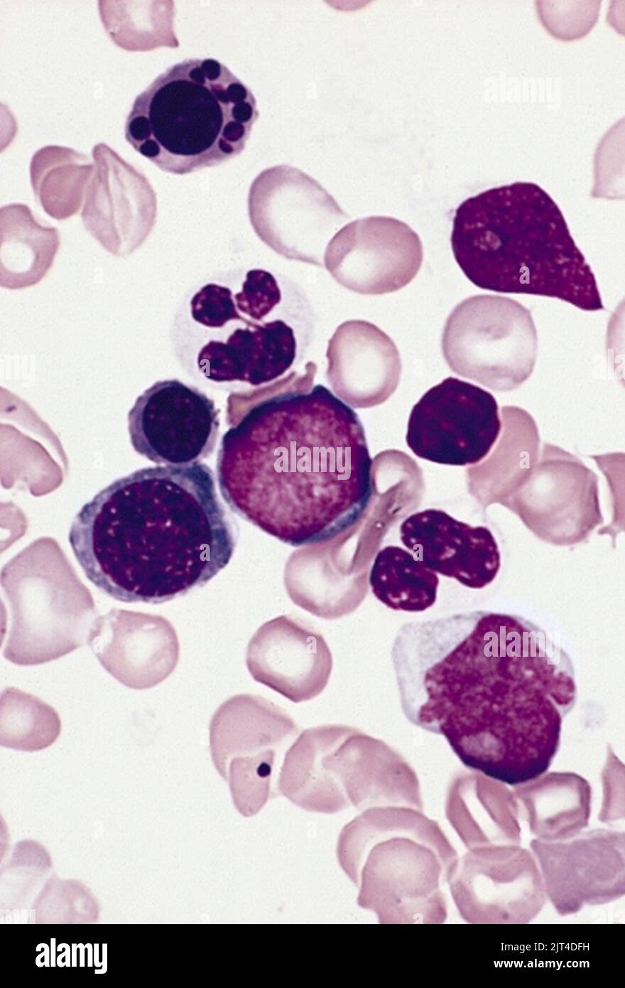 Two hypogranular neutrophils and a red blood cell precursor with ...