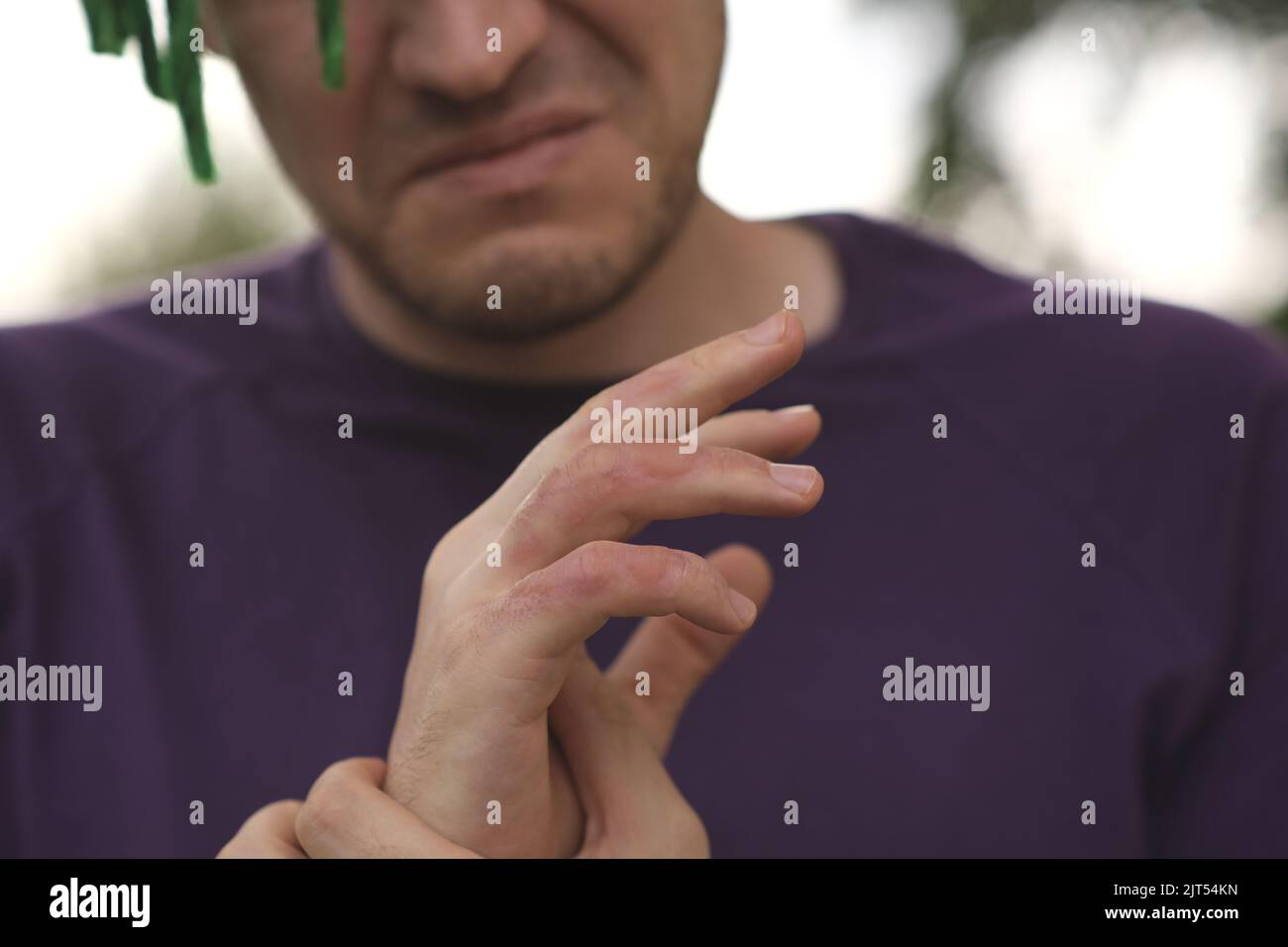 Man with burn on her hand, closeup. Burn blister on the hand. Hand male ...