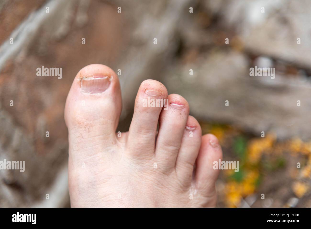 Human feet with uneven nails. Selective focus. anatomy. Feet Stock ...