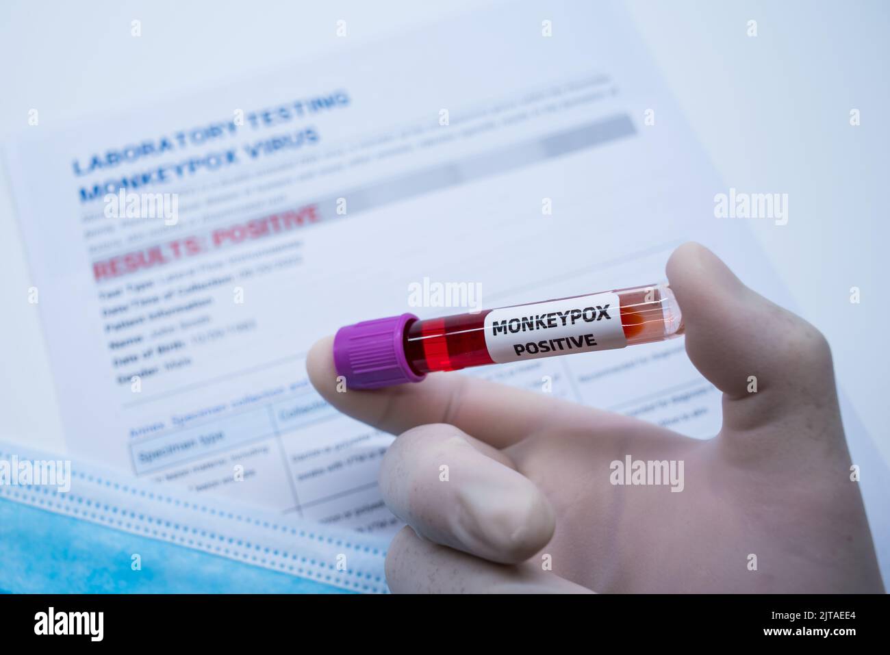 Blood collection tubes monkeypox test positive results Stock Photo - Alamy