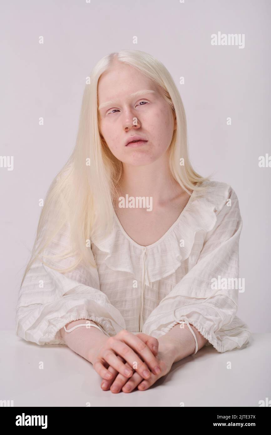 Portrait of young girl having albinism in elegant dress looking at ...