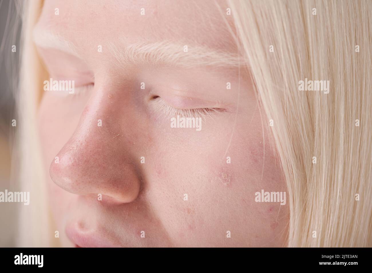 Close-up of young albino girl with natural appearance with white ...