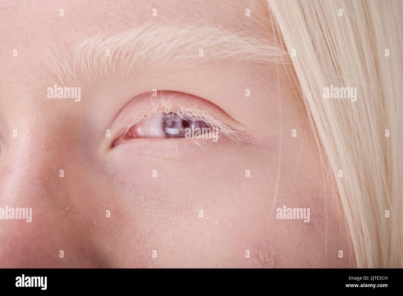 Close-up of young face of albino girl with blue eyes and white ...